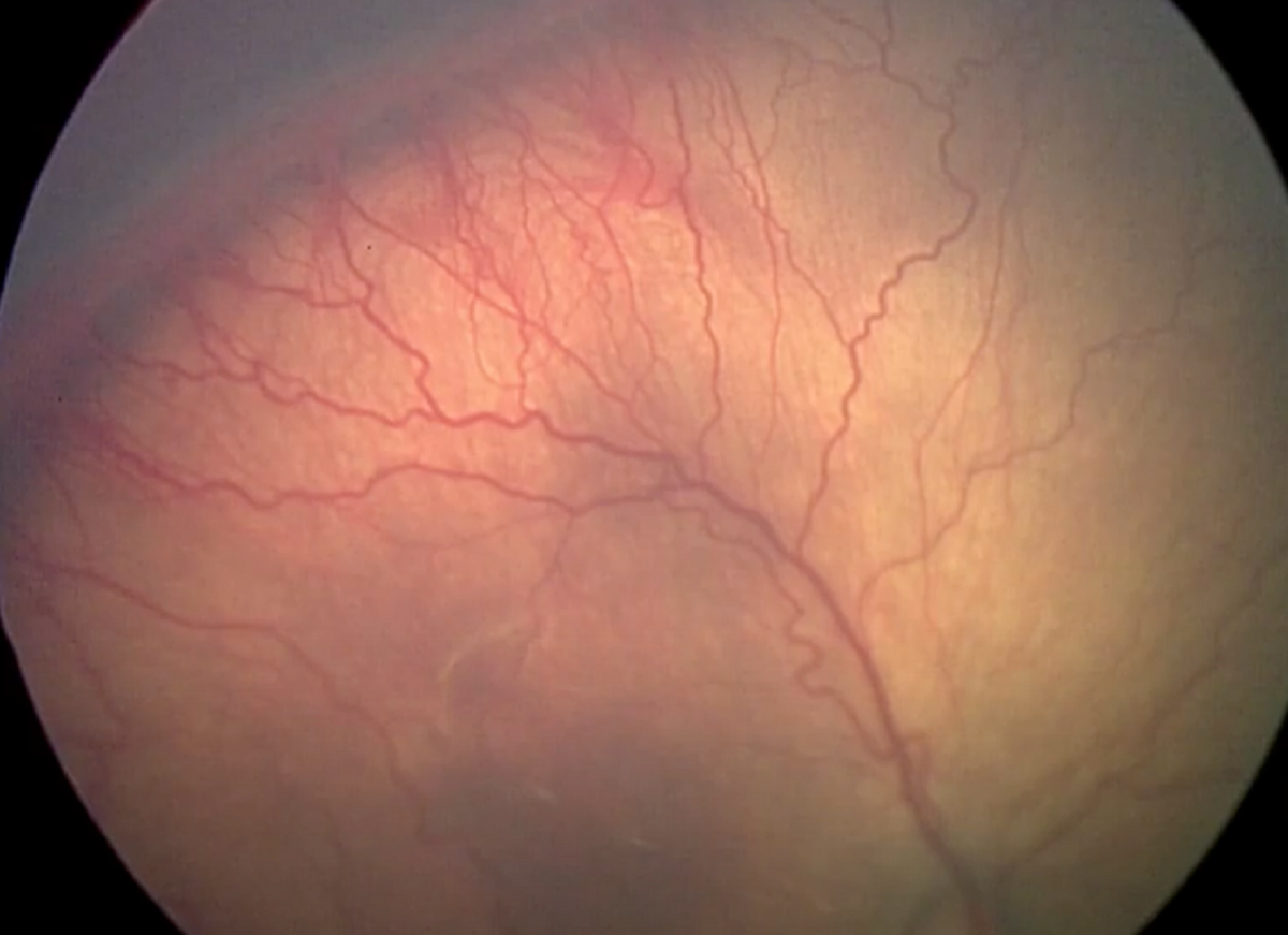 Retinopathy of Prematurity Stages and How it Affects Vision | LV