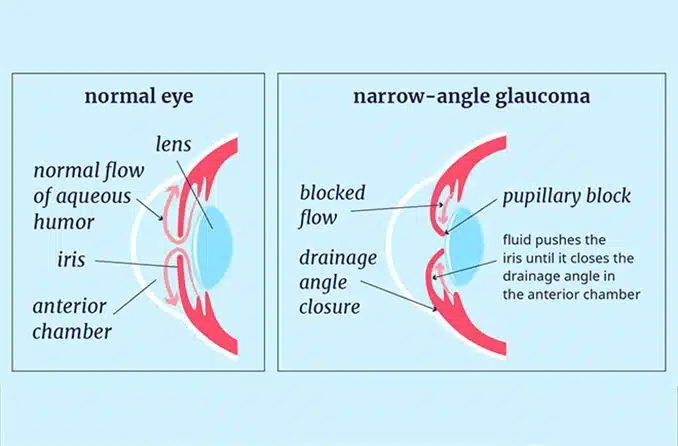 Anatomical Narrow Angle Glaucoma: Causes, Symptoms & Treatment