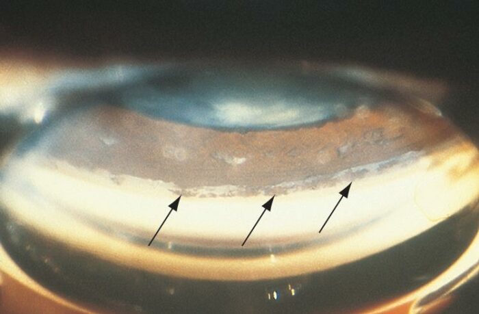 Angle Recession - Causes, Symptoms, and Treatment Options