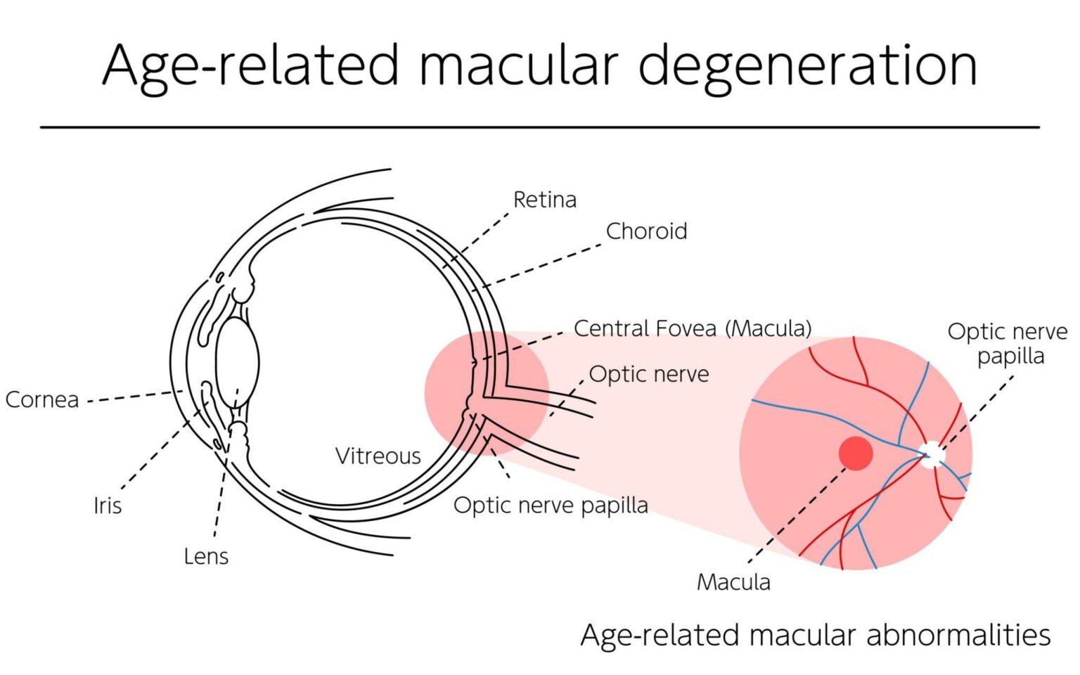 What Is The Main Cause of Macular Degeneration? | Blog
