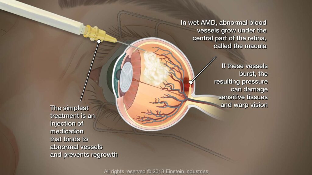 What is Macular Degeneration Treatment? - Low Vision Aids