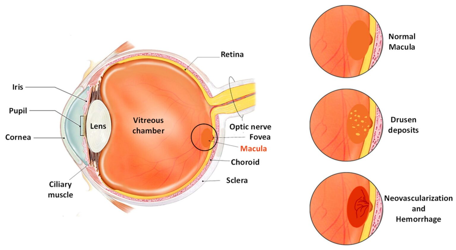 Wet Macular Degeneration Injections and Side Effects - Low Vision Aids