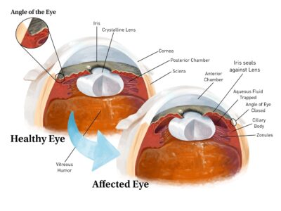 Pupillary Block Glaucoma - Causes, Symptoms, and Treatment