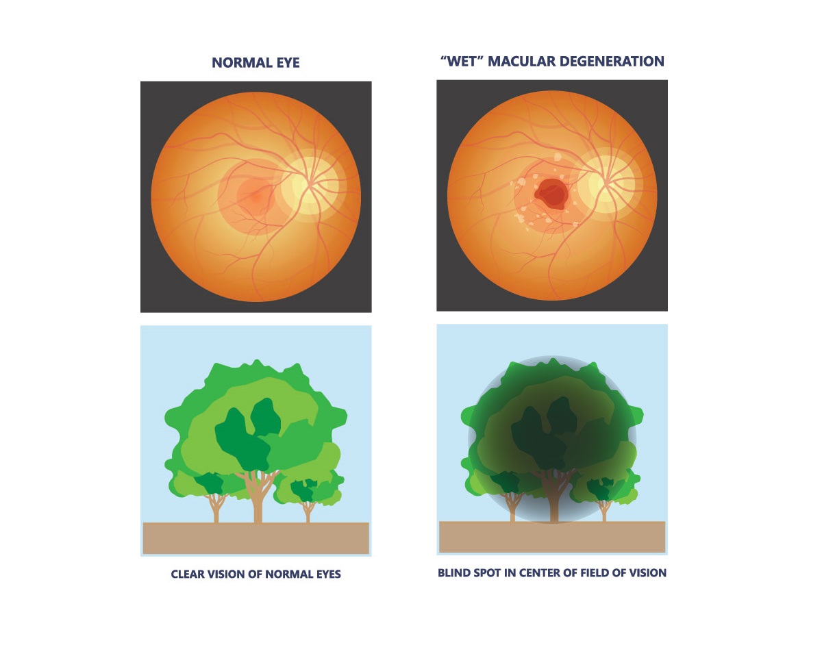 Wet AMD: Causes, Symptoms, and Treatment Options