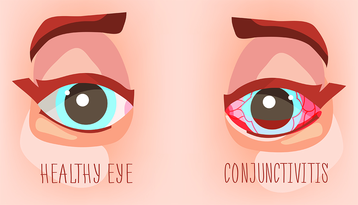 What You Need to Know About Conjunctivitis - Low Vision Aids