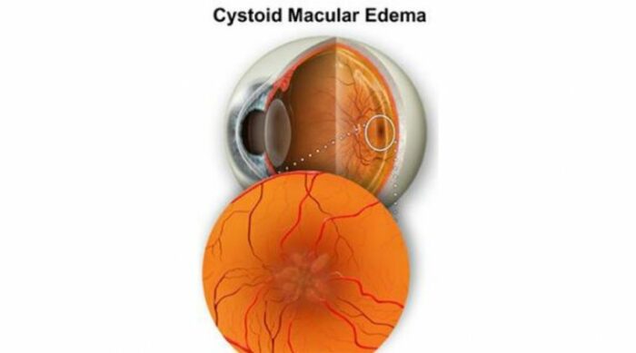 Cystoid Macular Degeneration - Know As Cystoid Macular Edema (CME)