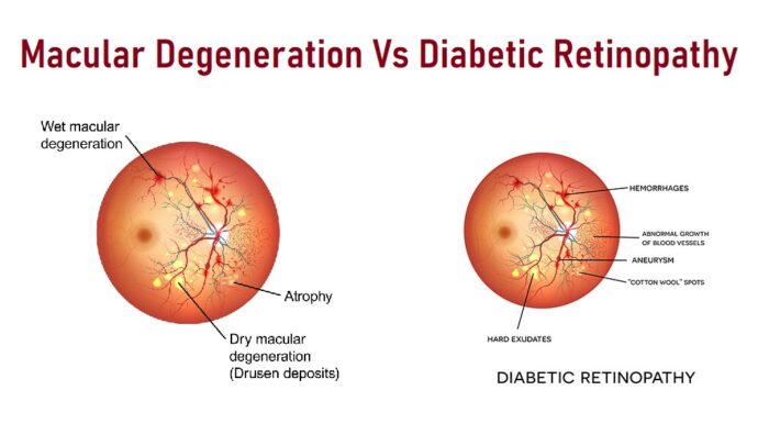 Macular Degeneration Vs Diabetic Retinopathy - Difference | Low Vision