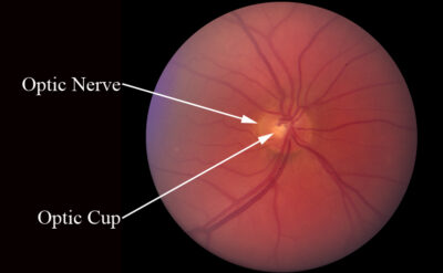 Optic Nerve Cupping - Causes, Reversal, And Treatment
