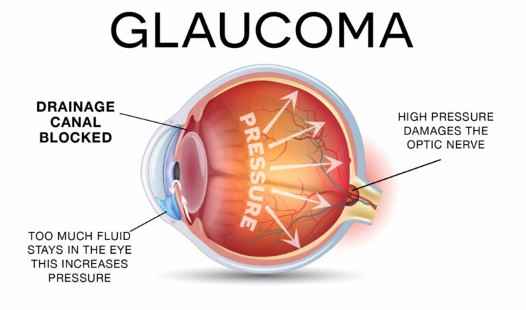 Stages of Glaucoma | Low Vision Blog