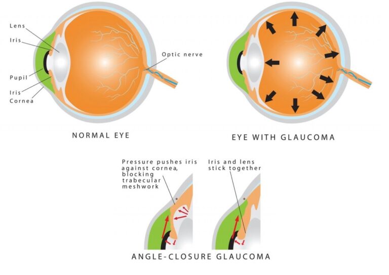 Acute Angle Closure Glaucoma - Low Vision Aids