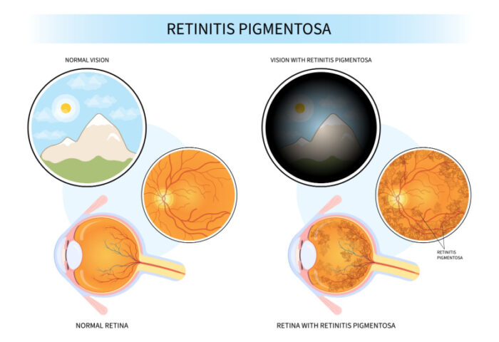 Retinitis Pigmentosa Inheritance | Low Vision Blog