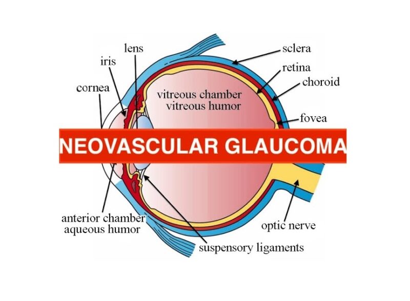 Neovascular Glaucoma: Causes, Symptoms, and Treatments