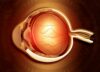 Macular Pucker Demystified - What You Need to Know