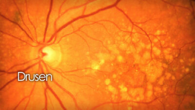 What is Drusen Macular Degeneration? | Low Vision Aids