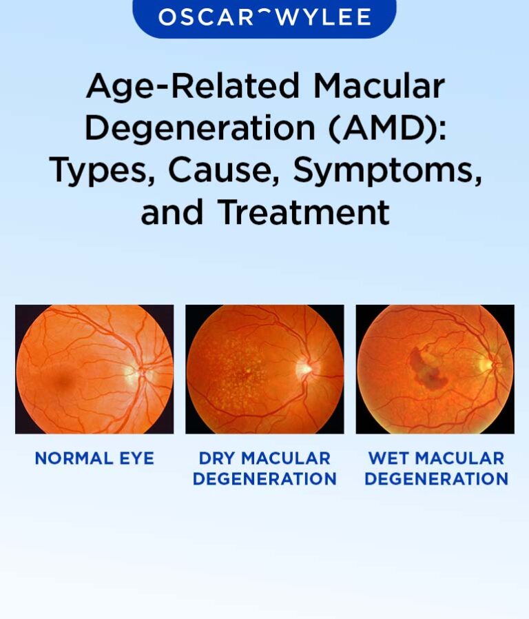 Treatment for Blurred Vision: Macular Degeneration Insights
