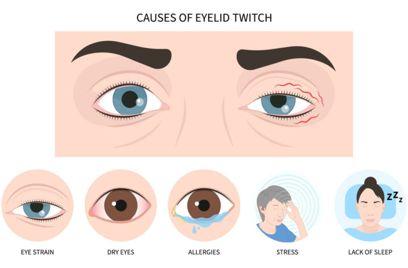 Why Is My Eye Twitching? | Causes, Symptoms & Relief Options
