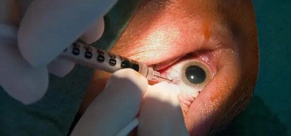Avastin Eye Injection Explained: Cost & Effectiveness